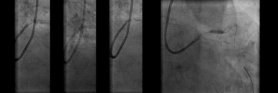 Case study: a calcified LAD Type III perforation