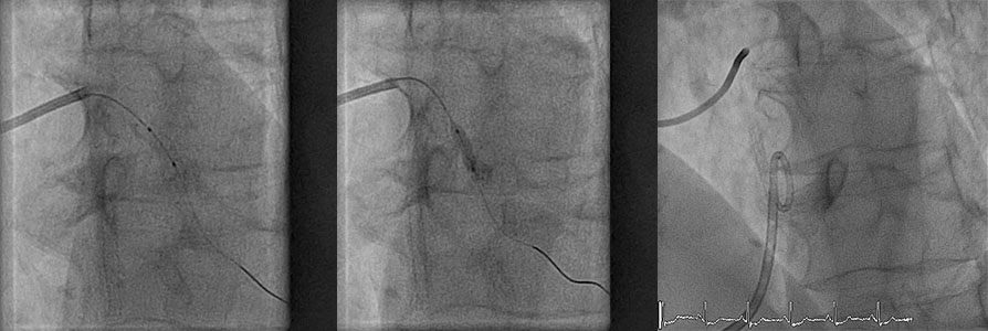 Case study: a Ramus Type III perforation
