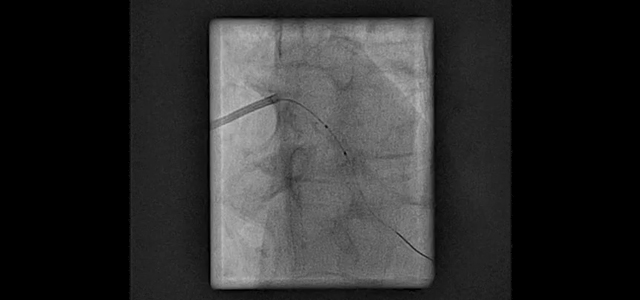 Case study: a Ramus Type III perforation