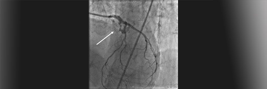Case study: an iatrogenic perforation of the left main during PCI