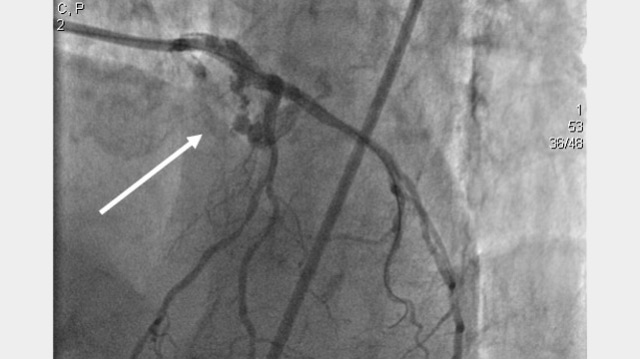 Case study: an iatrogenic perforation of the left main during PCI