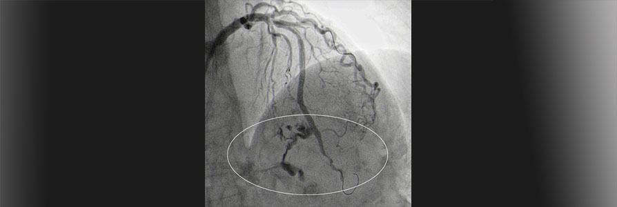 Case study: a coronary Type III perforation during left anterior ...
