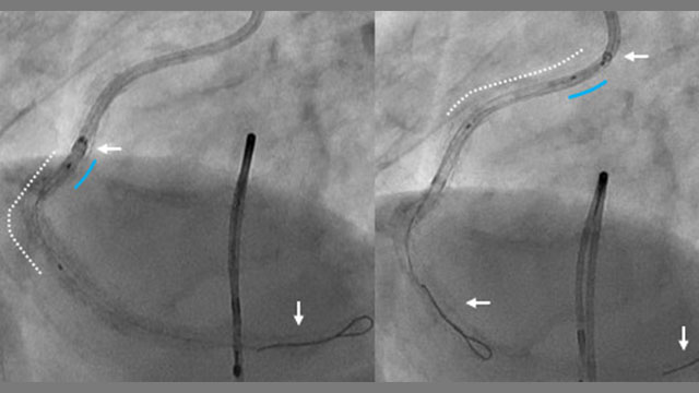 Guideliner Catheter