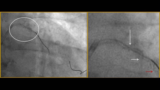 Case study: a rare case of intracoronary guidewire fracture