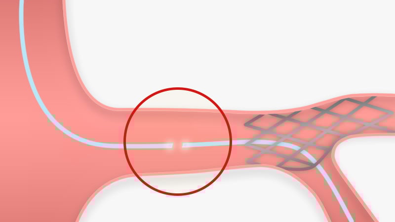 Coronary wire loss: part of jailed wire behind stent struts confined to ...