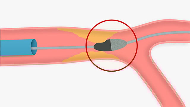 Rotablator: stuck burr or blocked rota and shaft fractures