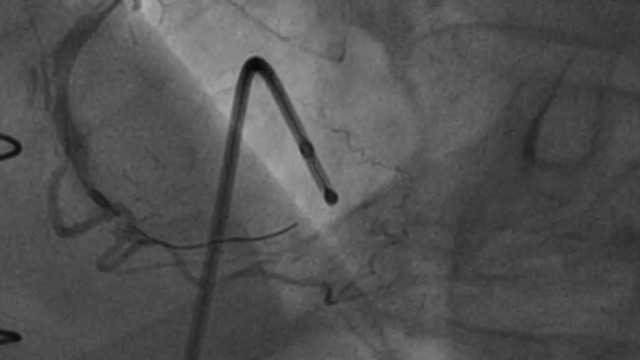Case study: entrapment of a rotablator in a freshly implanted stent ...