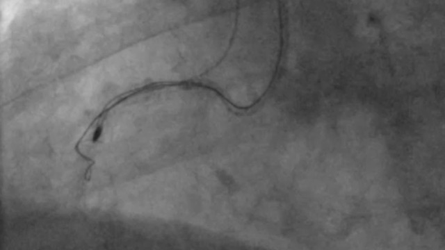 Case study: my most memorable radial case - a stuck Rota burr