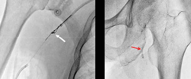 Stent loss above or below the common femoral artery