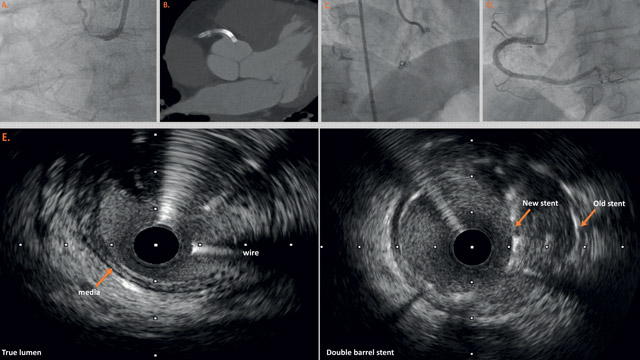 Double barrel in CTO PCI