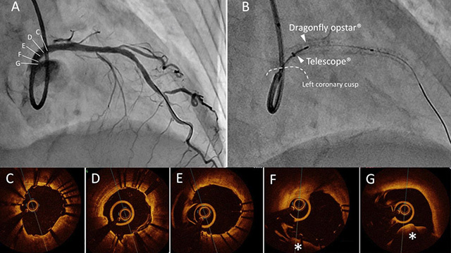 Observing an aorto-ostial lesion using TELESCOPE® in optical coherence ...