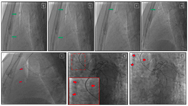 Bubble trouble: aortic air embolization and de-embolization during ...