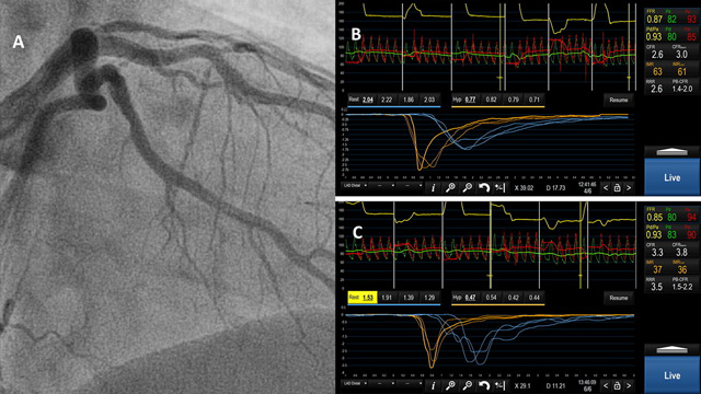 Coronary sinus reducer for microvascular angina