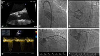 TAVI (Transcatheter aortic valve implantation)