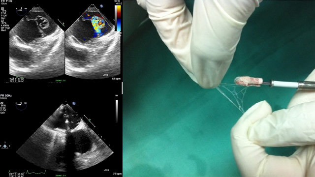 Swinging through the Web; Mitraclip implantation in a patient with ...