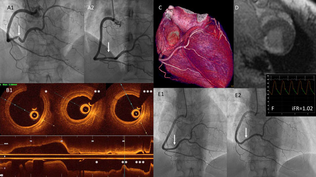 Multimodality guided management of an unusual case of STEMI