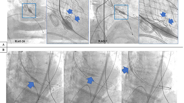 Post-dilation from contralateral access site for nose cone entrapment ...