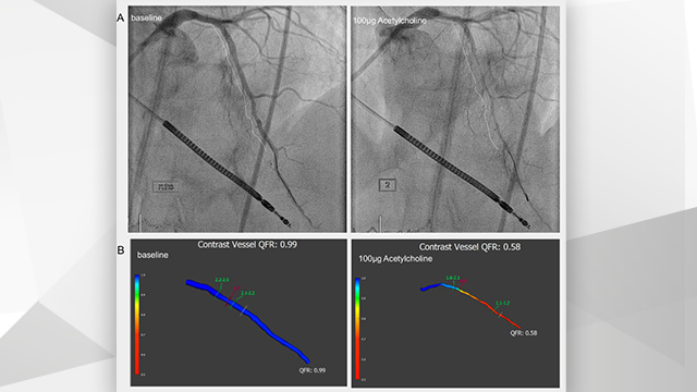 Angiography-based quantitative flow reserve in coronary vasospastic angina