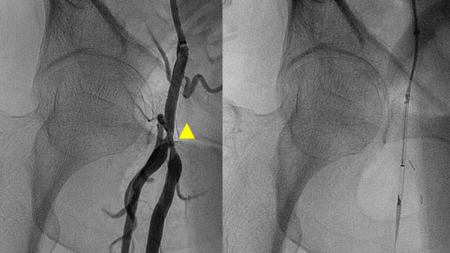 Iliac / Femoral / Popliteal