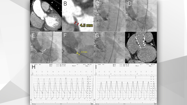 Simultaneous aortography and left ventriculography for transcatheter ...