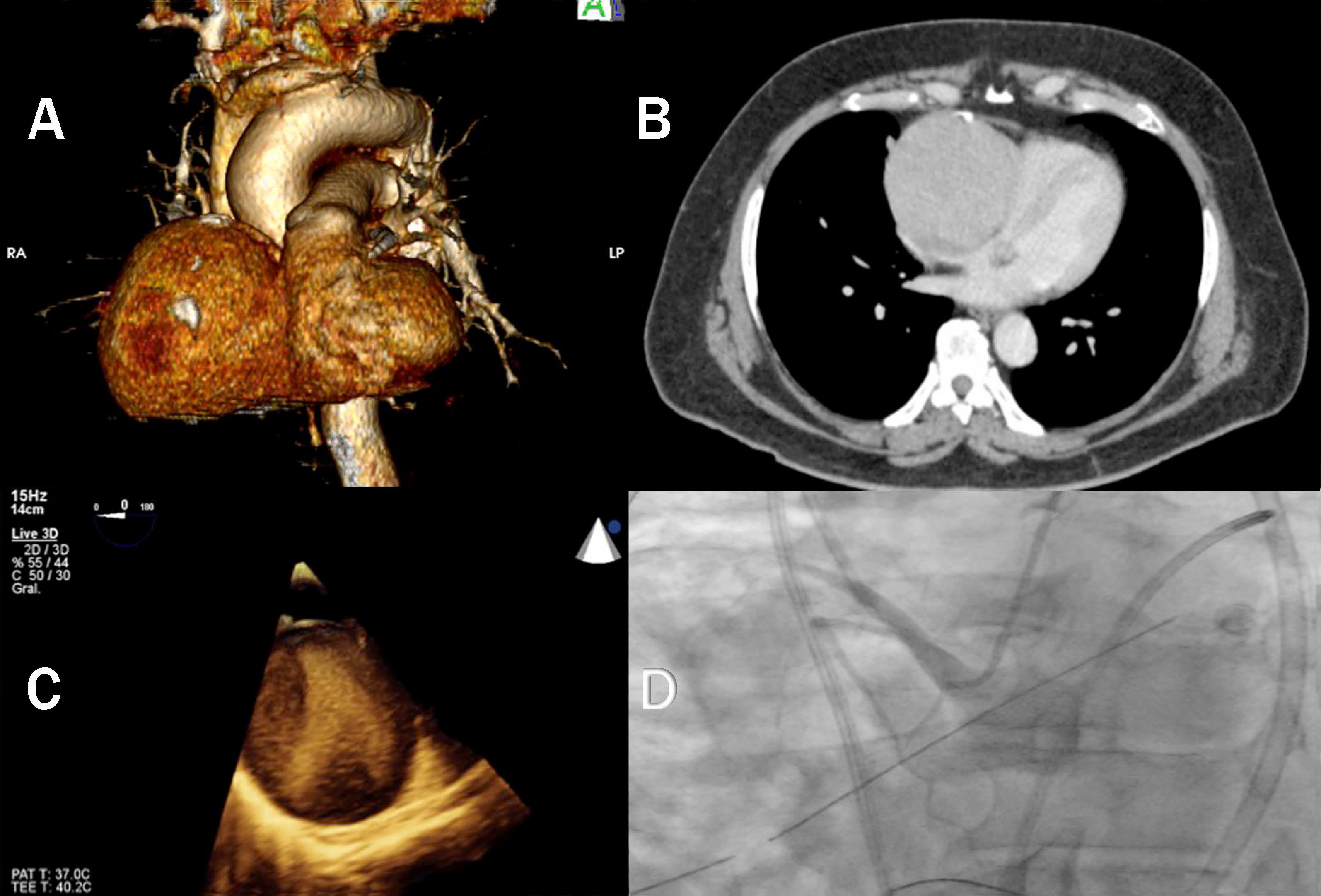 An unexpected giant cardiac mass - Image 18