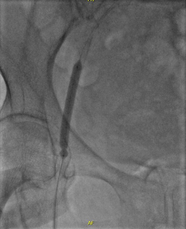 Hourglass-like stenosis