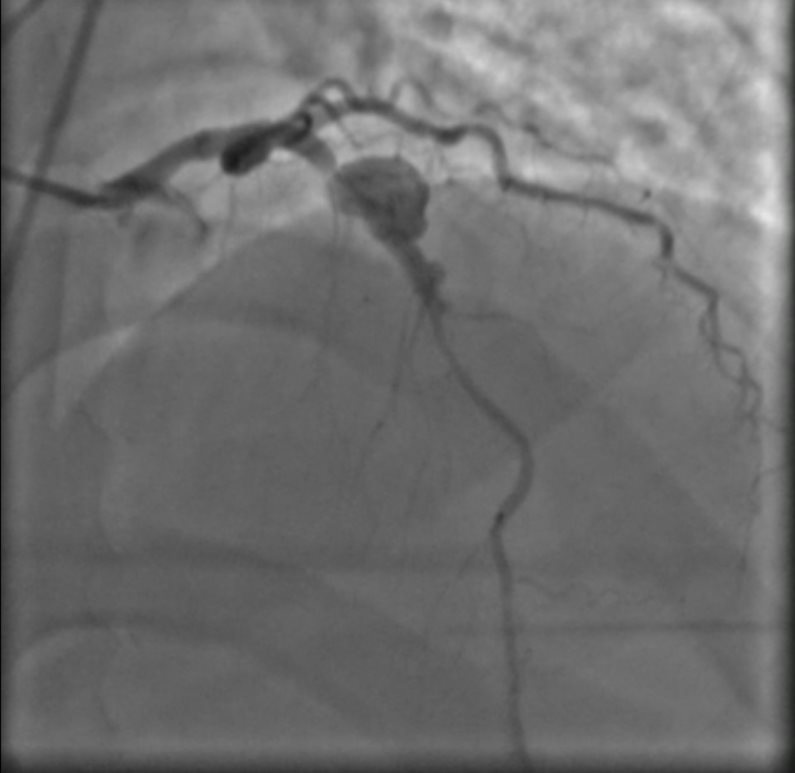 Unexpected finding in patient after primary PCI