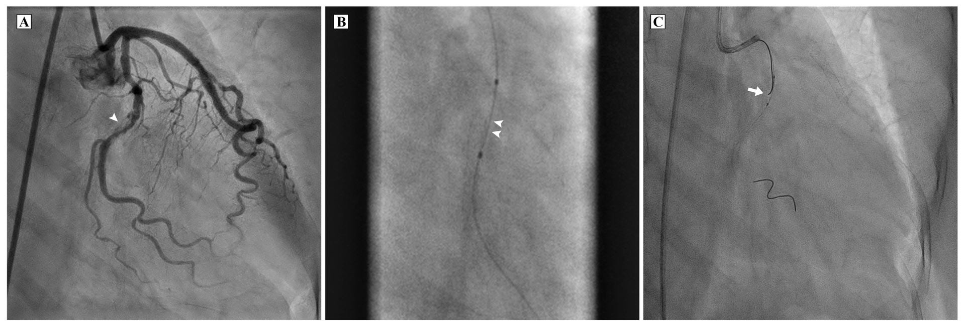 The balloon deflection technique