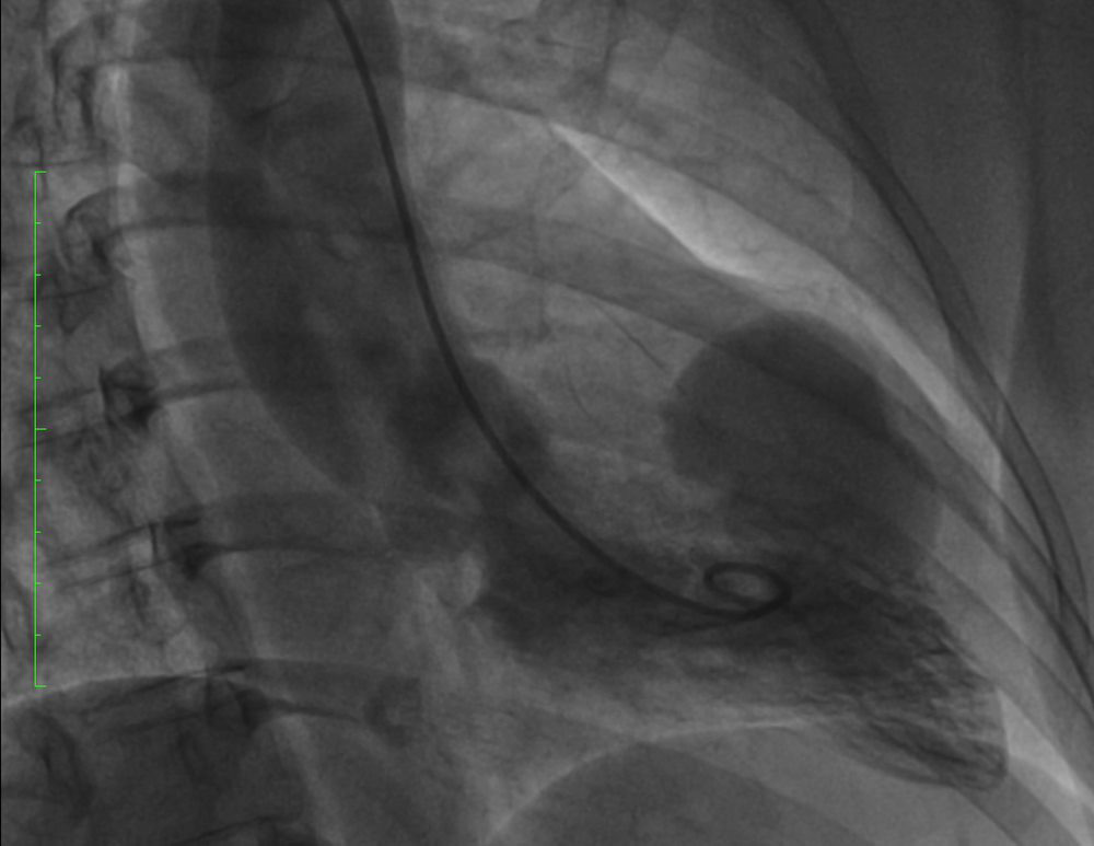Inoue balloon over left ventricle