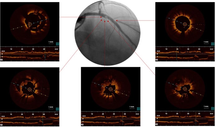 A coronary incidental finding