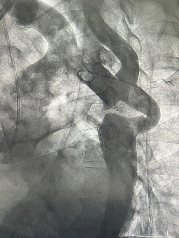 A surprising aortogram