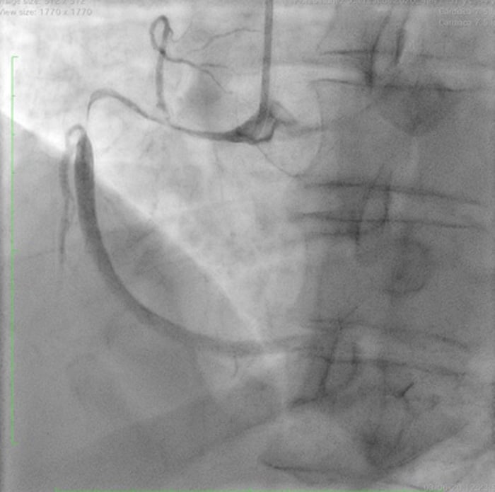 Is it an acute STEMI with a double culprit lesion?