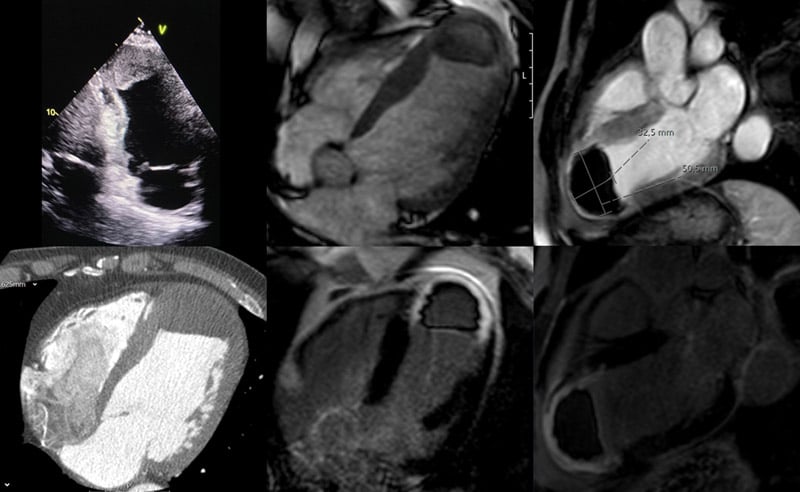 Multimodality imaging of a dangerous complication
