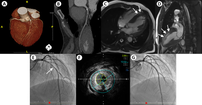 Patient with dizziness and exertional chest discomfort who ended up ...