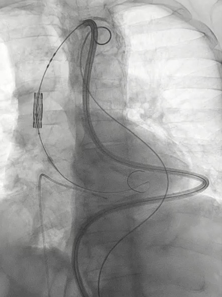 The long and winding road of a prosthetic valve
