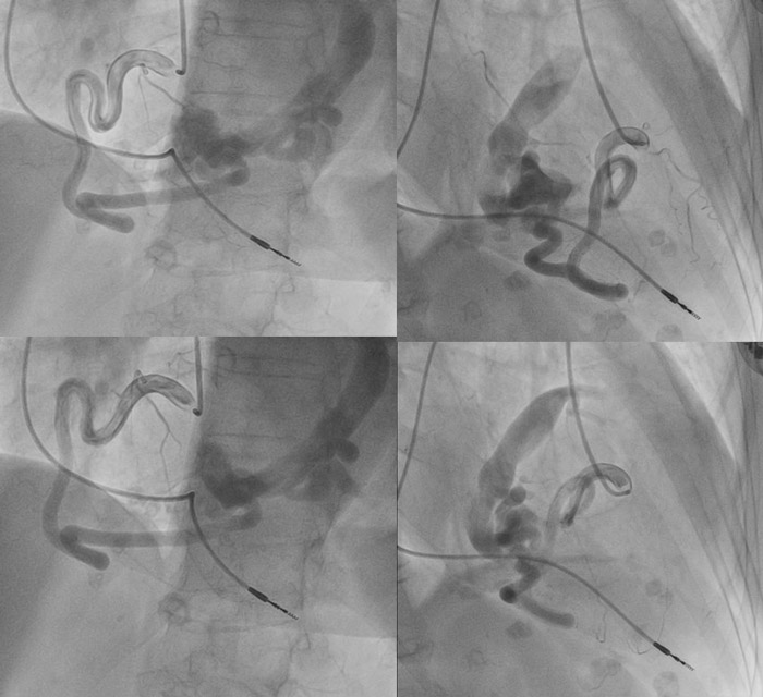 When a conventional coronary angiography acquires a new relevance