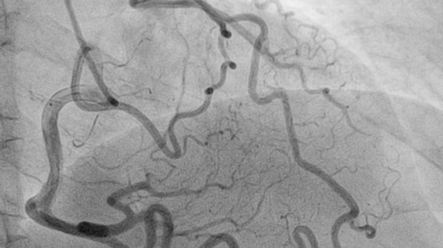 Unveiling the uncommon in the cath lab