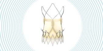 TAVI (Transcatheter aortic valve implantation)