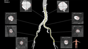 TAVI (Transcatheter aortic valve implantation)