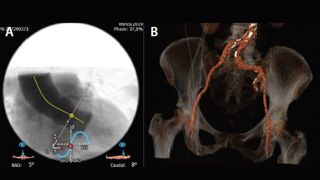 Transfemoral TAVI in the horizontal aorta