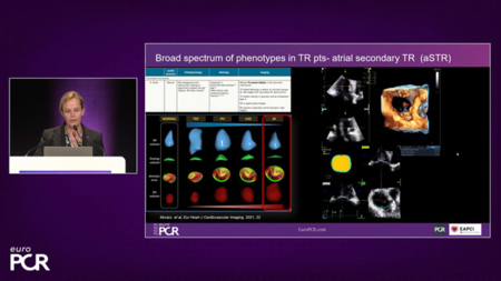 EuroPCR 2023 Highlights: Interventions for Valvular Disease