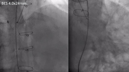 ST-segment elevation myocardial infarction (STEMI)