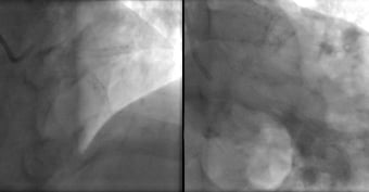 CTO (Chronic total occlusion)