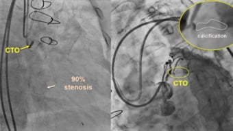 CTO (Chronic total occlusion)