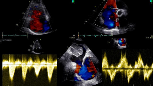 A team approach to the management of tricuspid regurgitation