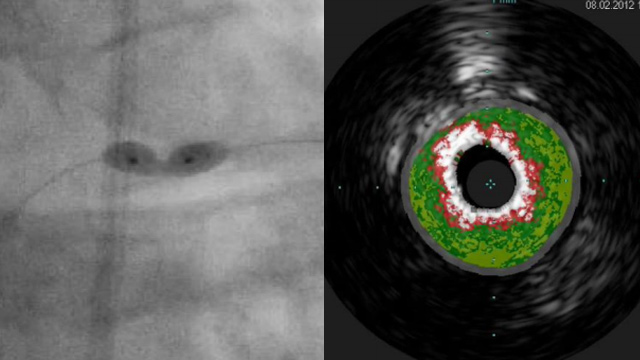 Advanced guidance, preparation and treatment tools in complex PCI