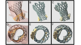 TAVI (Transcatheter aortic valve implantation)