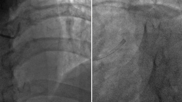 Bifurcation PCI: practical considerations