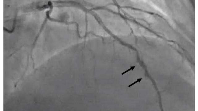 BRS cases with poor outcomes