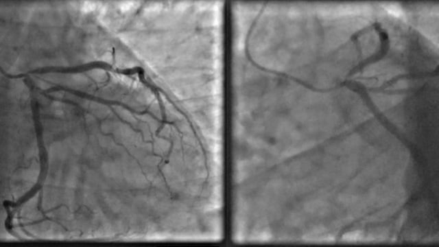 Calcified left main lesion PCI